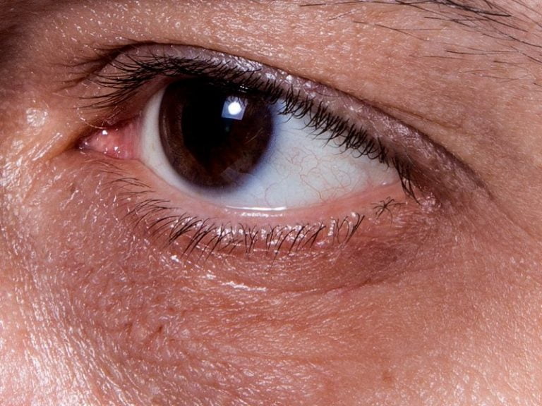 Rejuran i Treatment Singapore | Reduce Dark Eye Circles