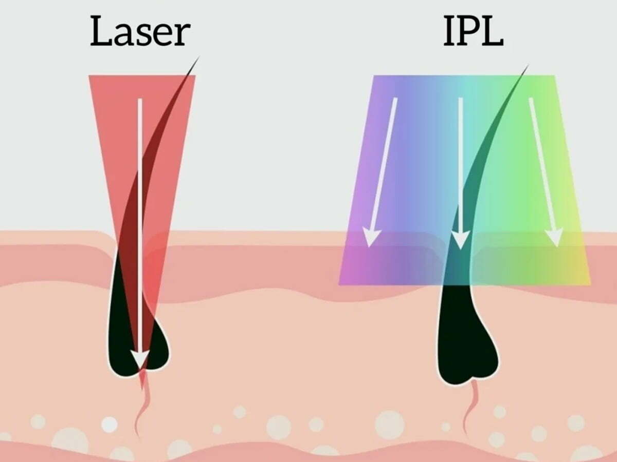 Laser Hair Removal $28 Nett | Painless With Permanent Results