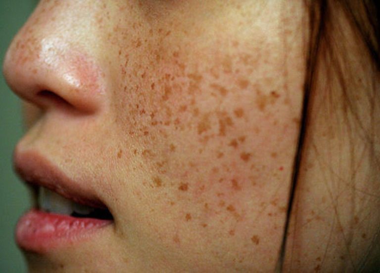 Know your pores! Y to U to O-Shaped, We’ve Got You Covered!