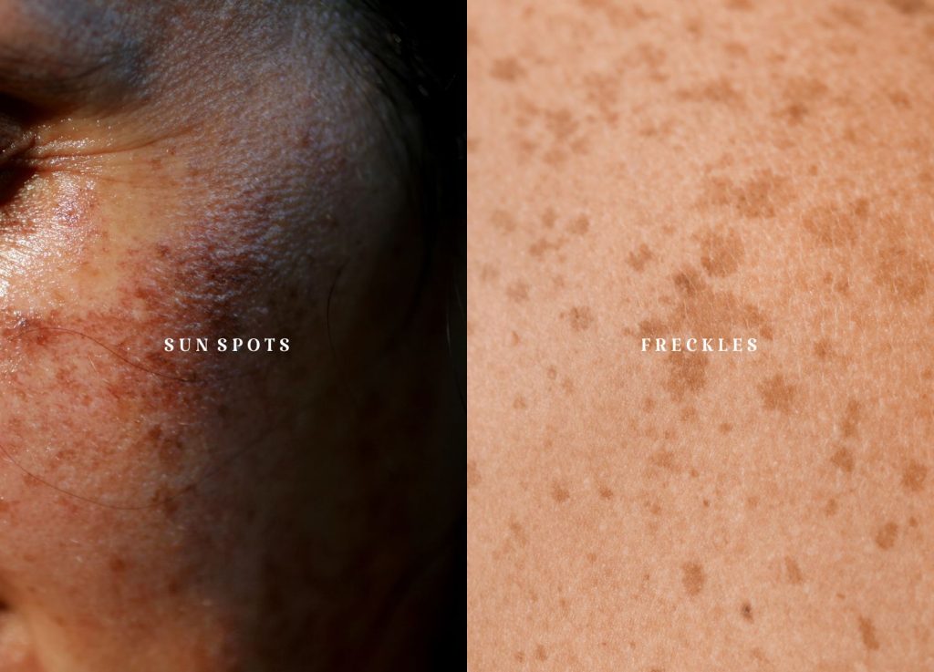 Pico Laser: Is It Right for Sun Spots or Freckles?