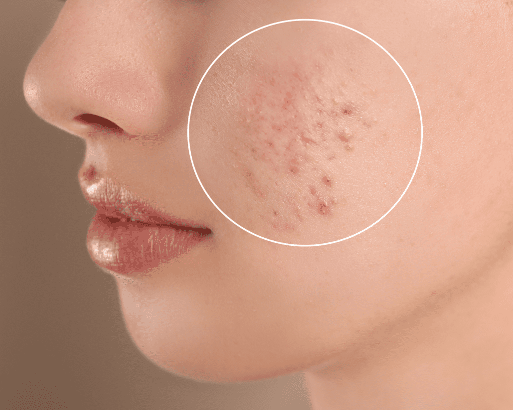 Acne Is Common: Here’s What You Need to Know